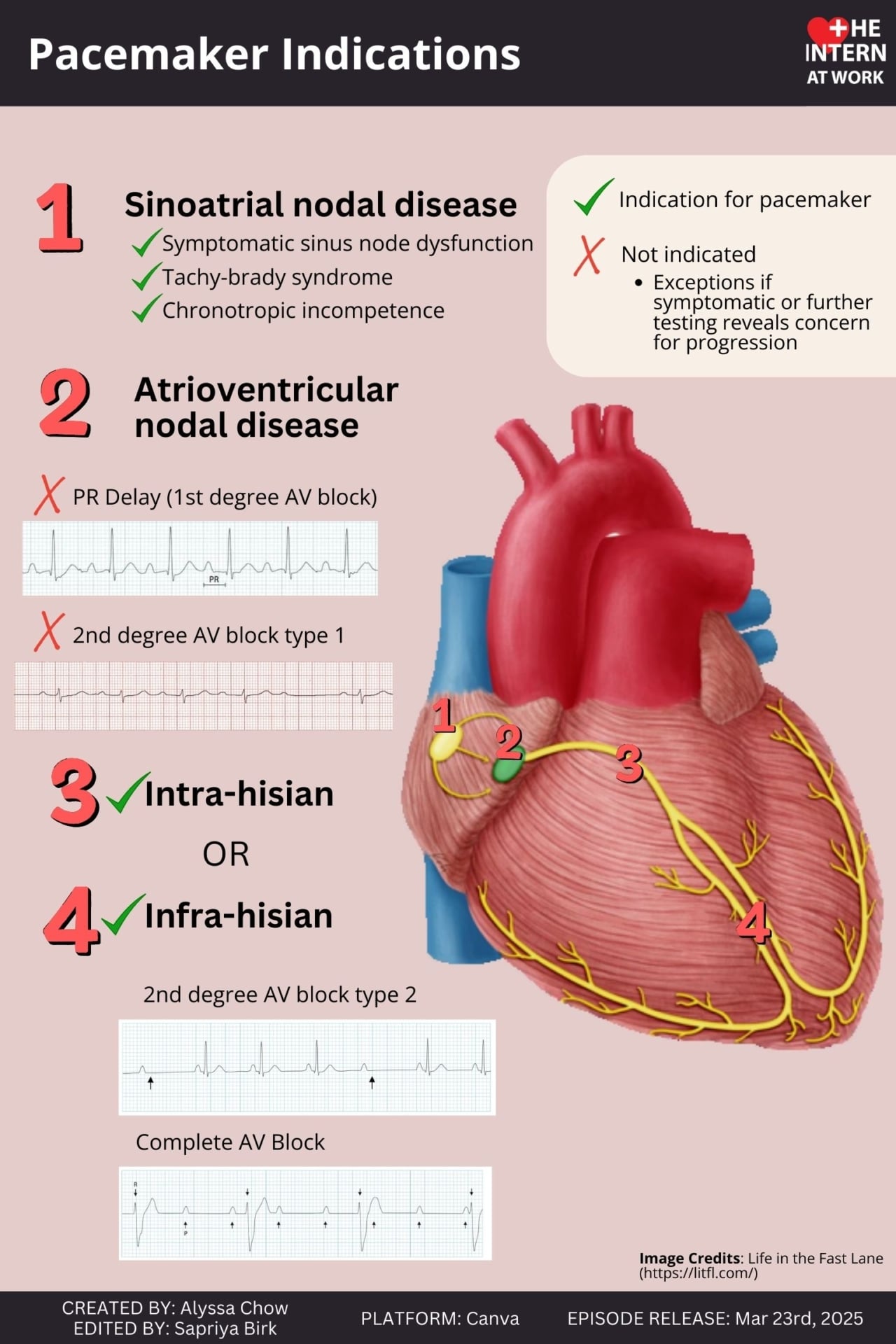 Pacemaker Indications - Medicine Pods